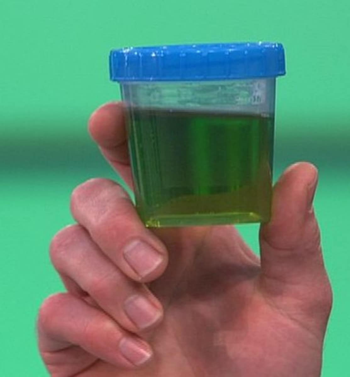 Green Urine Causes, Concerns, and When to Seek Medical Attention ...