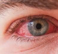 What Does Pink Eye Look Like? Signs, Symptoms, and Pictures - Fitness Today